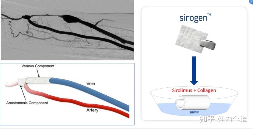 【行业资讯】雷帕霉素洗脱胶原植入物（SIROGEN） - 知乎