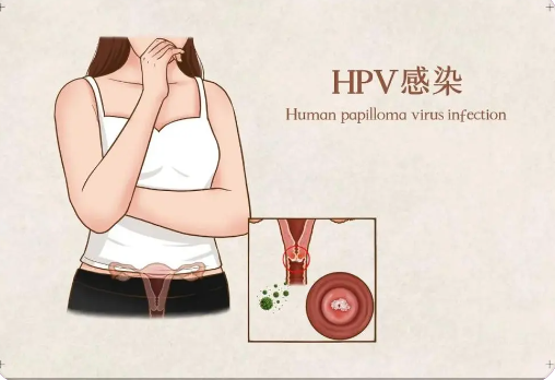 从宫颈/阴道高级病变HSIL(VaIN2-3)的治疗到HPV转阴 - 知乎