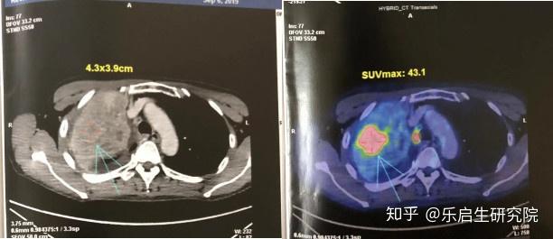 癌症免疫疗法联合放化疗抗癌，什么时候介入最佳？ - 知乎