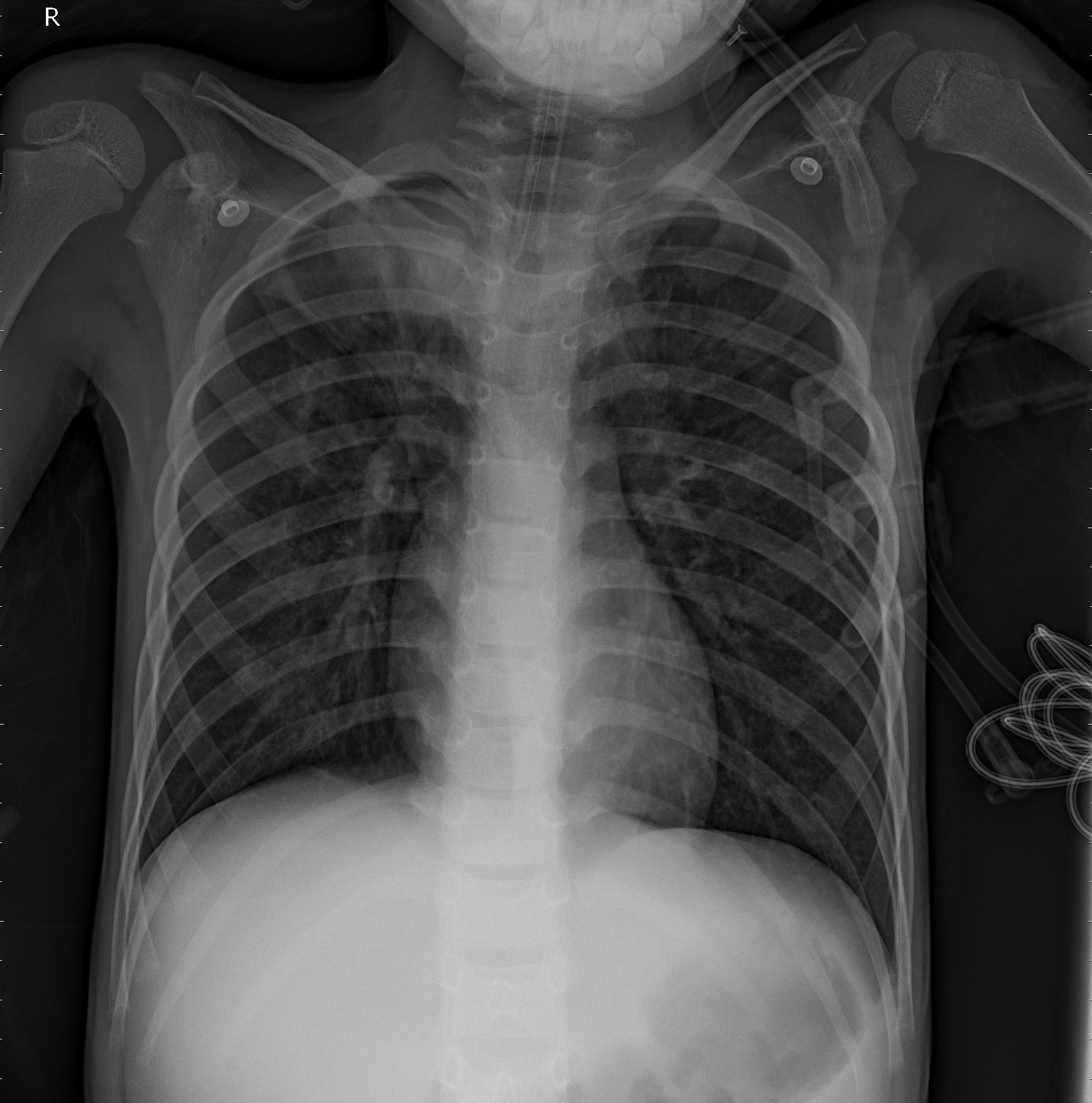 CoronaHack -Chest X-Ray 数据集介绍 - 知乎