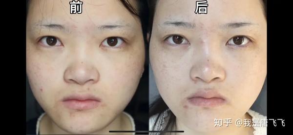 我去做超皮秒了，手术过程和30天恢复记录分享【整容】【医美】 知乎