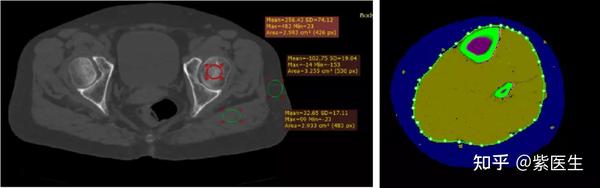 定量CT（QCT）是什么？临床应用有哪些？ - 知乎