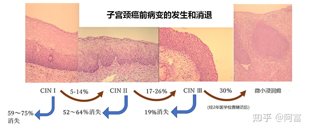秒懂 宫颈癌前病变 知乎