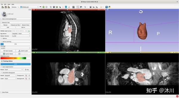 使用 DeepEdit 和 3D 切片器注释图像 - 知乎