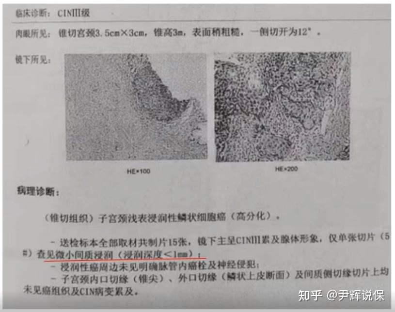 【尹辉重疾理赔专栏 Ep.02】—— CIN I CIN II 与CIN III ,HSIL,LSIL,VIN II,VIN III 哪些能 ...