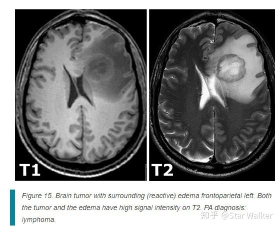 T2转T1，是无中生有，还是隐秘的角落？ - 知乎
