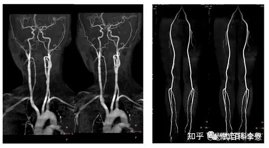 磁共振血管成像技术——流入增强TOF技术 - 知乎