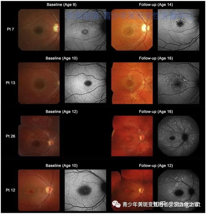 数据调查|儿童期Stargardt病的临床和基因特征 - 知乎