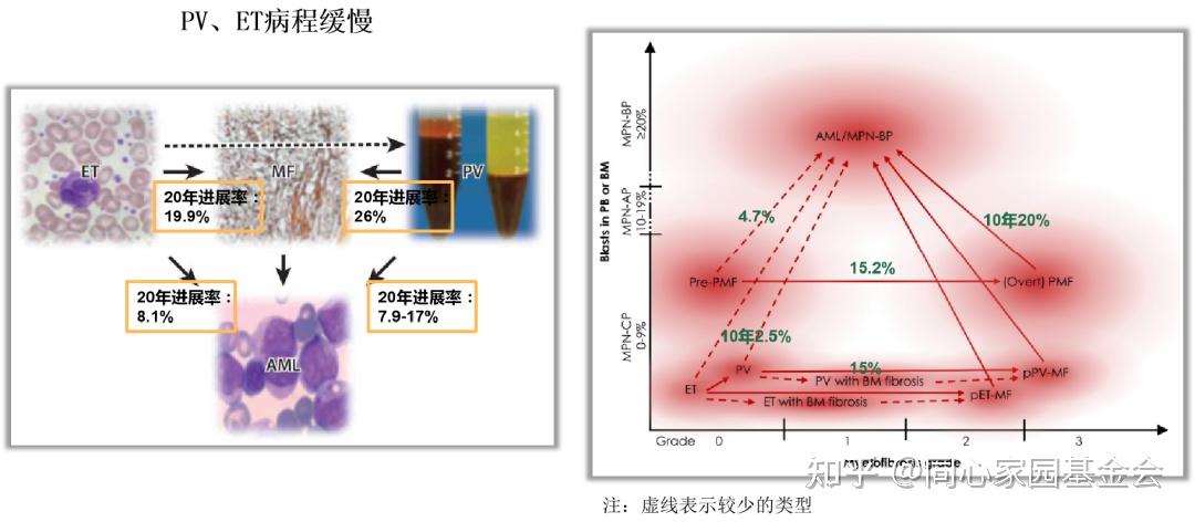 经典型MPN：PV/ET/PMF （1） - 知乎