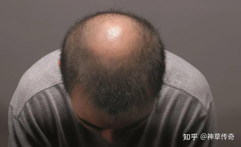 网友:为什么我的斑秃一边治一边掉,已治疗半月了,头发还没有长出来? 知乎
