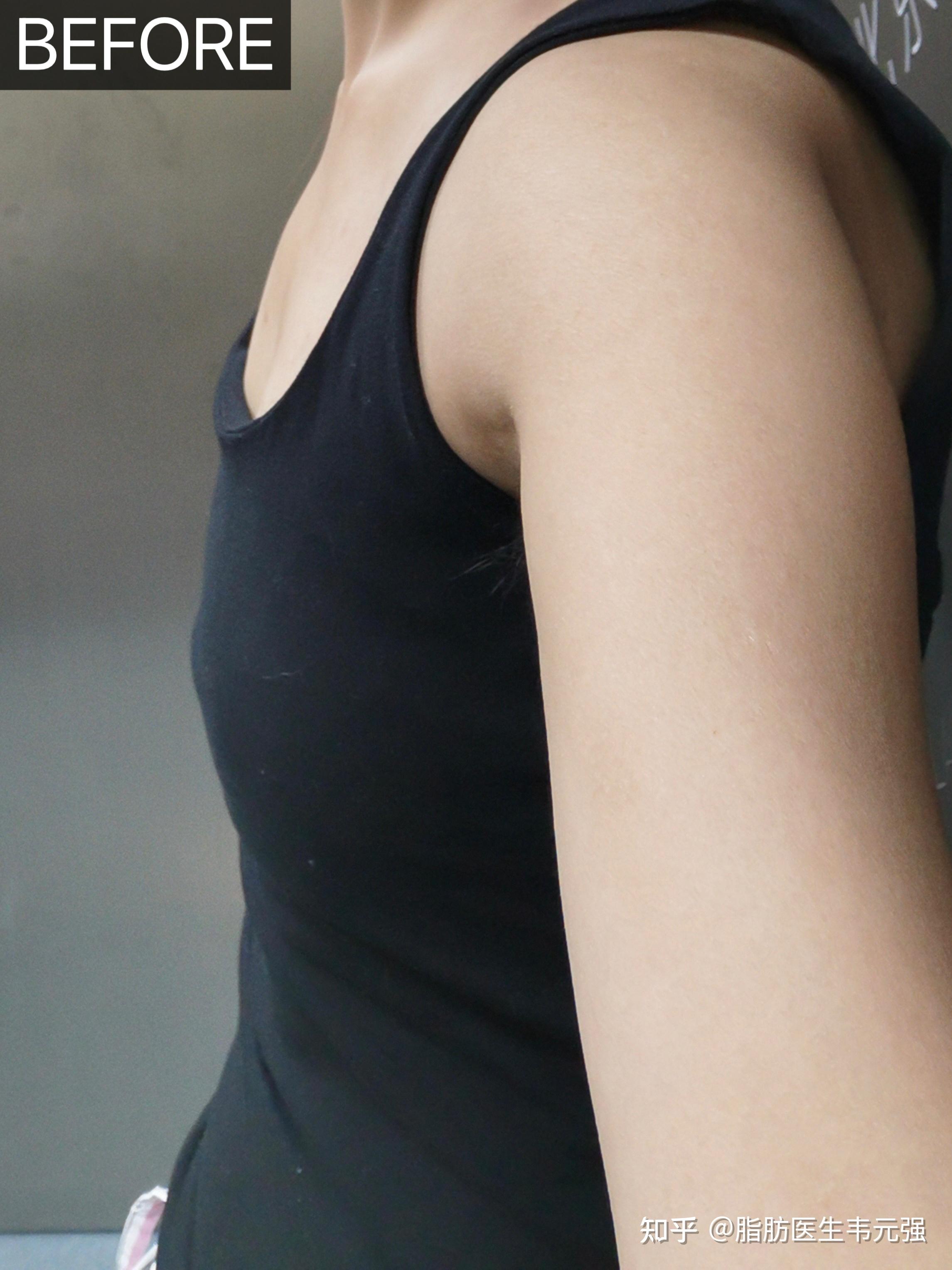 171cm/55kg江苏姑娘天生小胸,做完自体脂肪丰胸,终于说出了真相! - 知乎