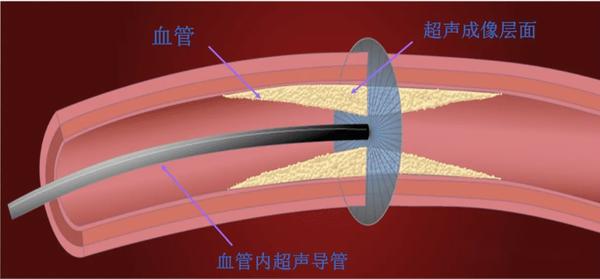 一文了解血管内超声 - 知乎