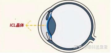 价格6万的ICL V5晶体植入究竟值不值得做？ - 知乎