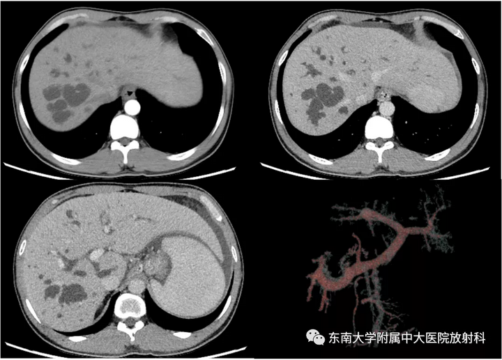 一学就会！Caroli病影像及临床表现 - 知乎