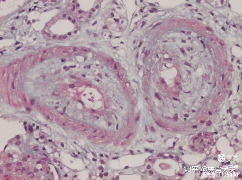 纤维素性微血栓、血小板微血、免疫血栓的鉴别诊断 - 知乎