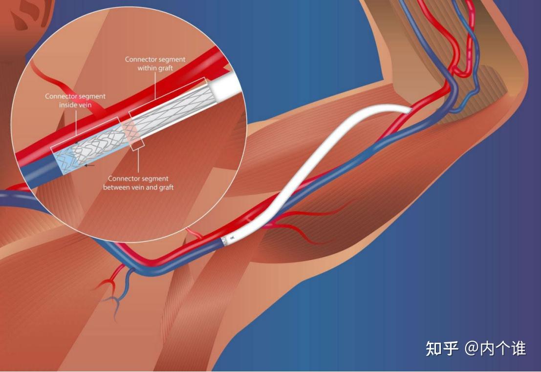 【行业资讯】EndoForce™血管腔内静脉吻合连接器 - 知乎