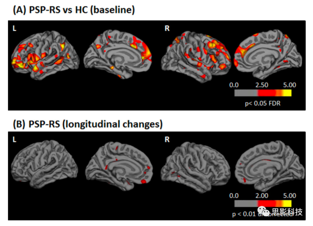 JNNP:追踪进行性核上性麻痹患者的脑损伤情况 - 知乎