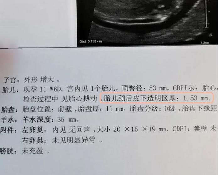 孕检时做的NT检测，到底是什么？做好功课NT一次过！ - 知乎