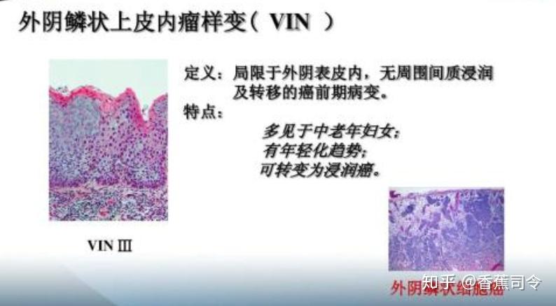 外阴上皮内瘤变（VIN） 是什么？怎么办？ - 知乎