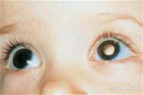 【ISPN/RN考题】“白瞳孔”是魔鬼瞳么？ - 知乎