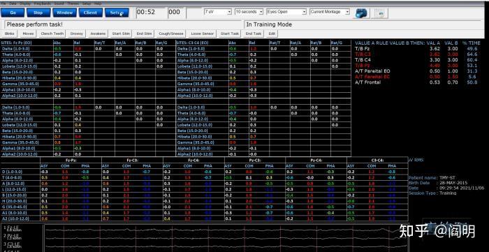 QEEG在抑郁症等神经系统疾病诊断中的应用 - 知乎