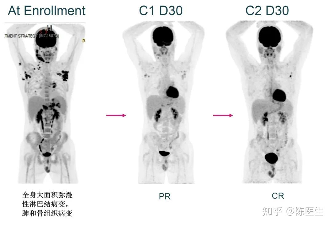 NK细胞“杀疯”癌细胞！肺癌、肝癌、淋巴瘤无处藏，筑牢抗癌先锋第一道防线！ - 知乎