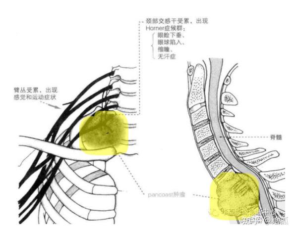 【呼吸系统】纵隔肿瘤 - 知乎