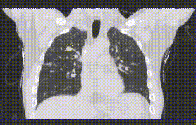 什么是4D CT？4D CT会带来很高的辐射剂量吗？ - 知乎