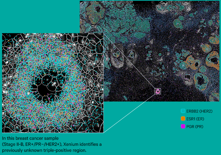 如何让大海捞针更精确？10x Genomics公司Xenium原位分析技术助力发现罕见的癌症生物学特征 - 知乎