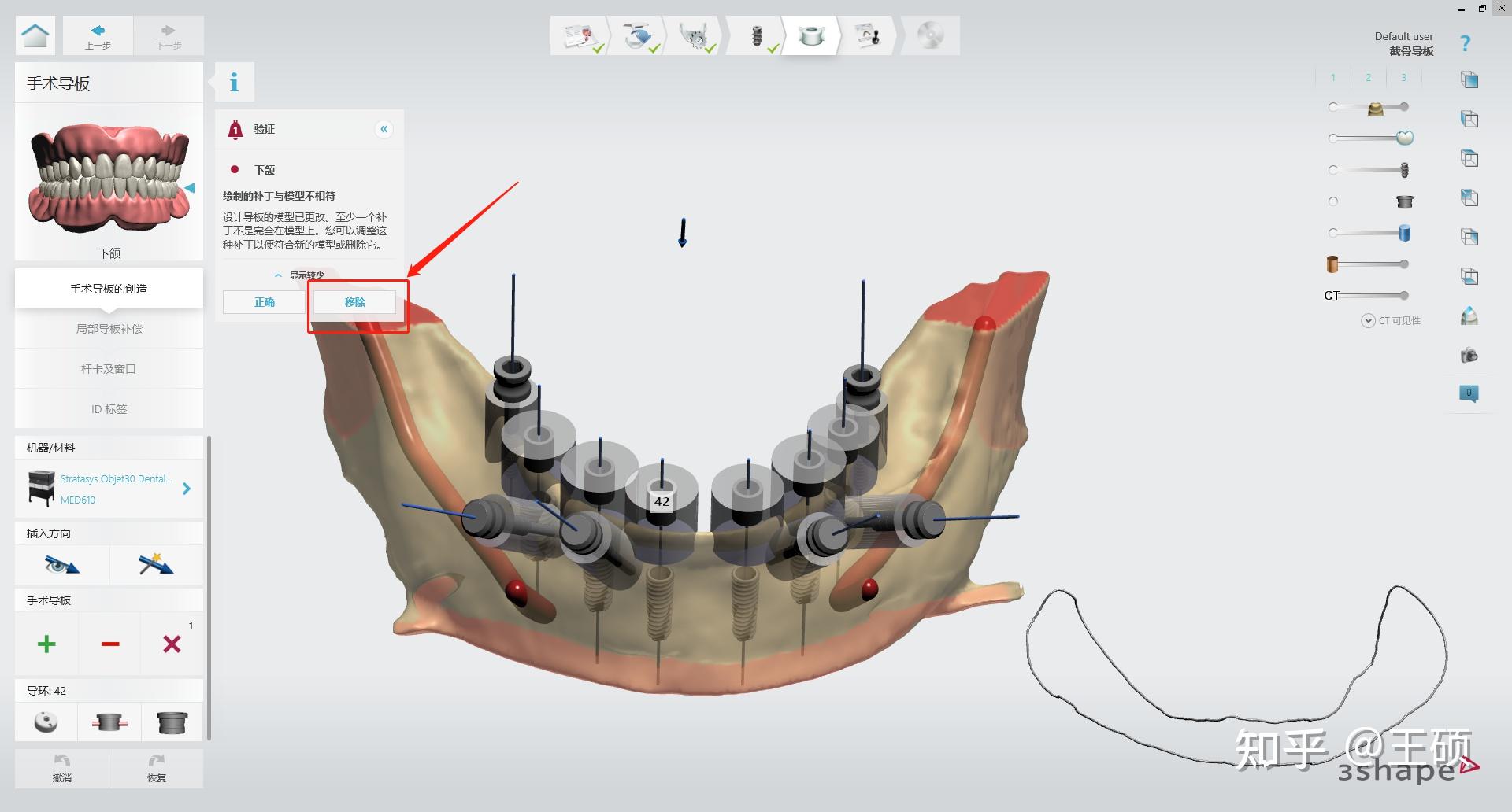 3shape-unite 骨支持式截骨导板流程细节 - 知乎
