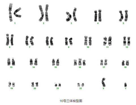图解 13（patau）三体综合症、18（Edwards）三体综合症，21（down）三体综合症 - 知乎