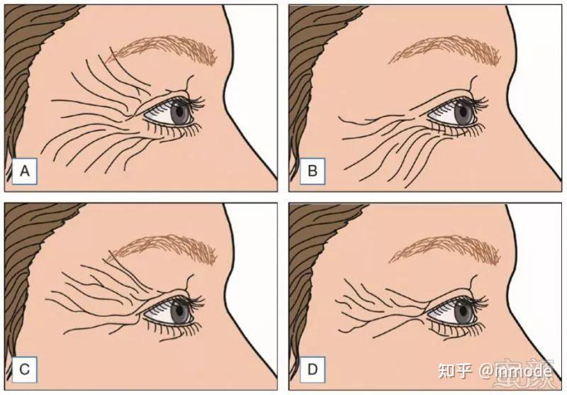 最显老的部位科普-其一：眼周皱纹 - 知乎