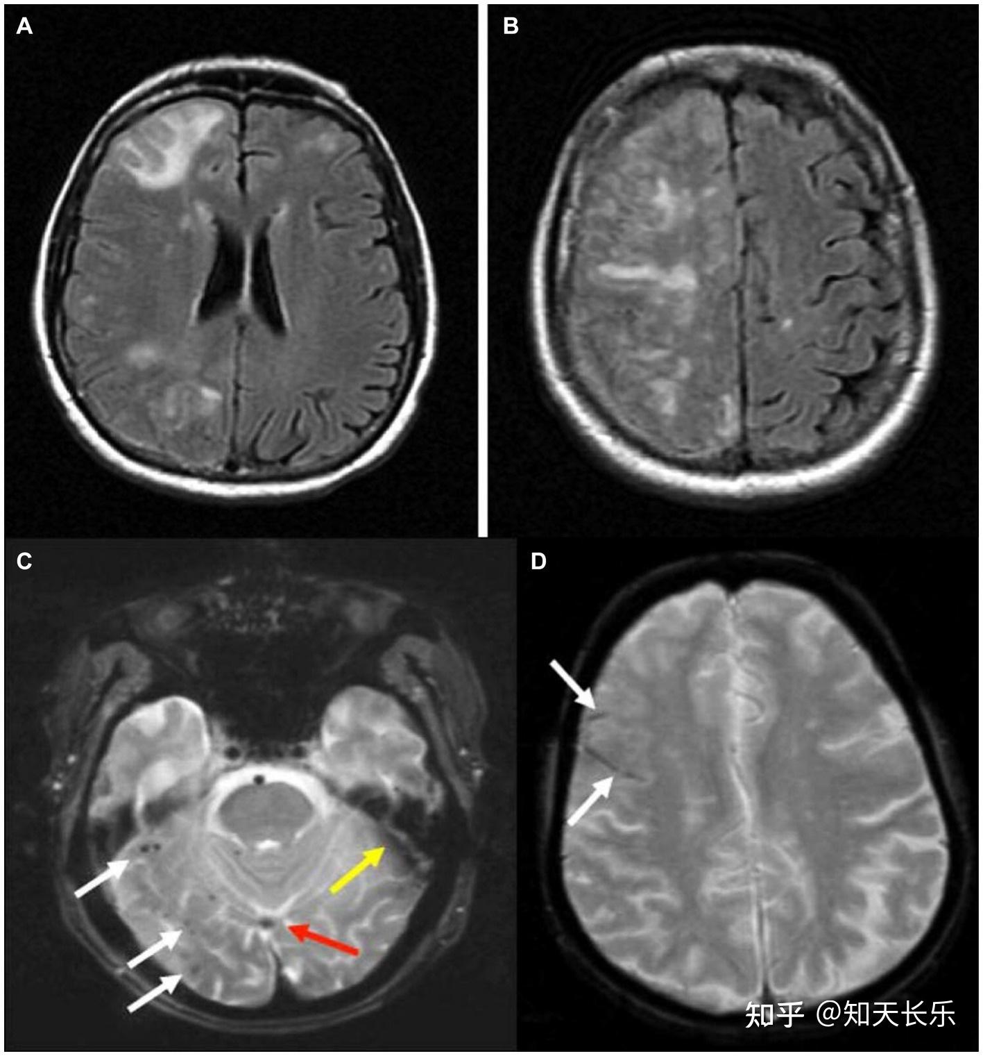 应用抗Aβ单抗治疗AD，引发淀粉样蛋白相关影像学异常（ARIA）的危险因素和临床意义 - 知乎