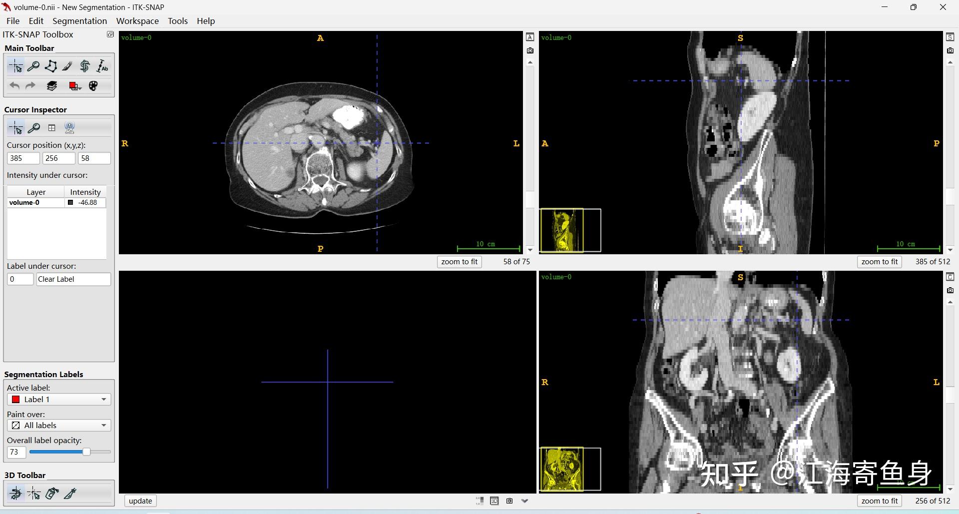 [项目实战]基于UNet的肝脏肿瘤多类分割（一）ITK-SNAP调窗 - 知乎