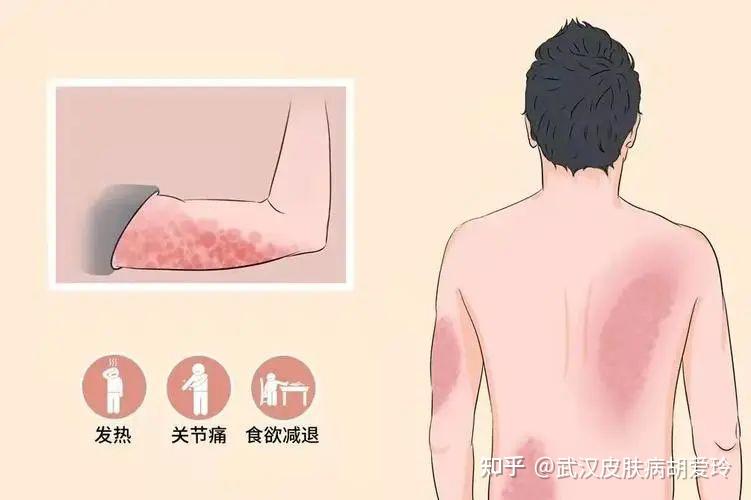 局限性硬皮病发展成弥漫性的怎么办 知乎