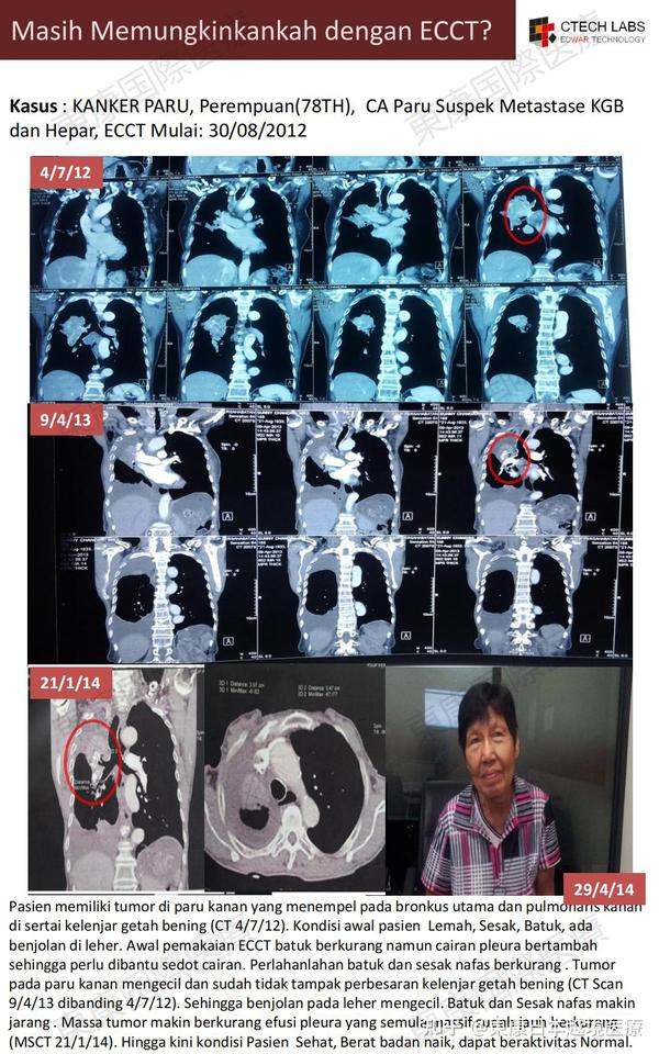 癌症治疗新利器ECCT电场治疗 - 知乎