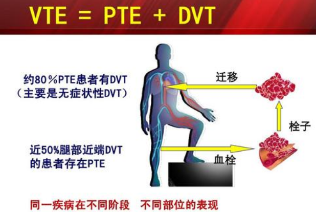 什么是临床上一致公认的VTE防治基础？ - 知乎