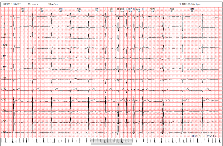 冠心病引起的T波的改变 - 知乎