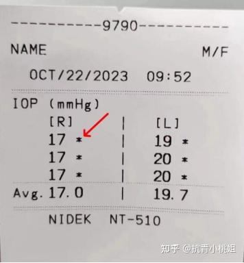 教你看懂自己的NCT眼压检查单 - 知乎