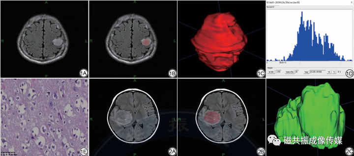 MRI直方图在DNET和弥漫性星形细胞瘤鉴别诊断中的价值 - 知乎
