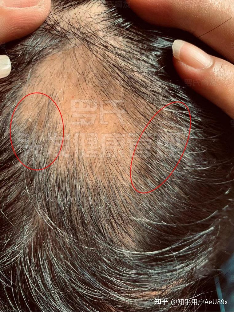 罗缔发域答疑为什么斑秃恢复期长出来头发是白色的？ 知乎