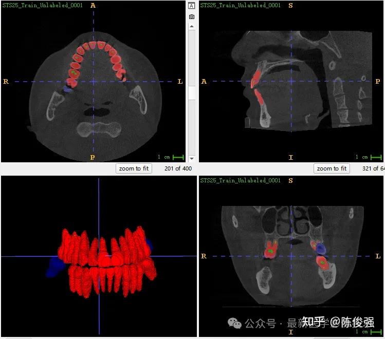 STSR2025——CBCT牙齿分割和CBCT与IOS注册配准 - 知乎