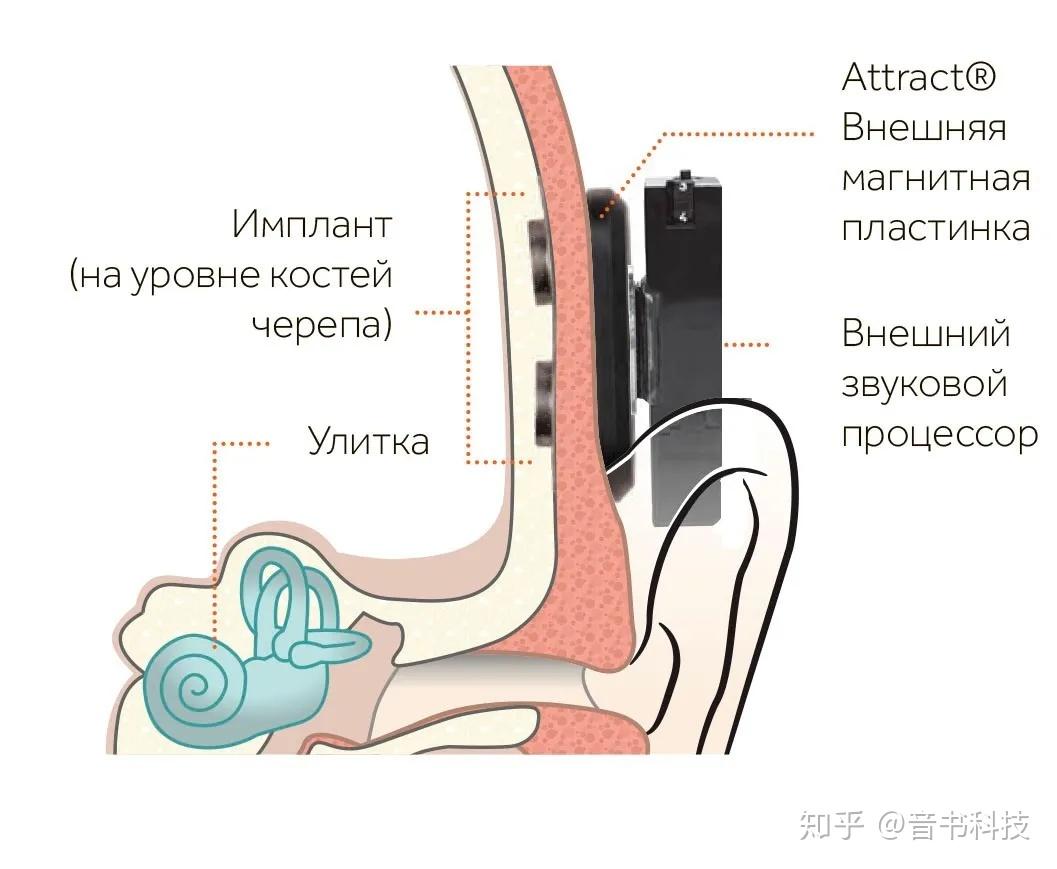 音书科普 | “小众”市场——骨导助听 - 知乎