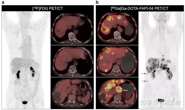 [68Ga]Ga-DOTA-FAPI-04 PET/CT---肿瘤研究新热点！ - 知乎