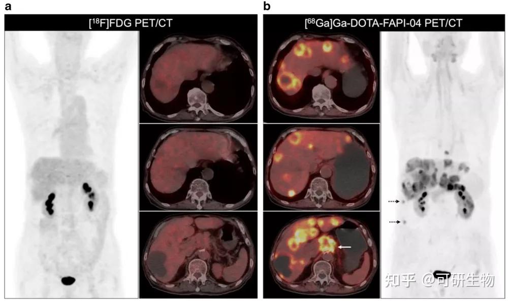 [68Ga]Ga-DOTA-FAPI-04 PET/CT---肿瘤研究新热点！ - 知乎