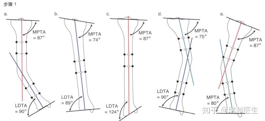 《矫形外科原则》读书笔记（二）-胫骨机械轴及解剖轴分析 - 知乎