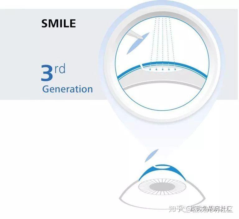 简述PRK/LASEK、LASIK与SMILE激光手术的异同 - 知乎