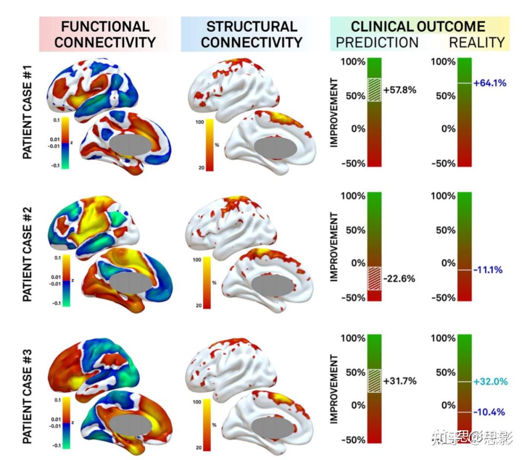 连通性可预测深部脑刺激（DBS）对帕金森的疗效 - 知乎