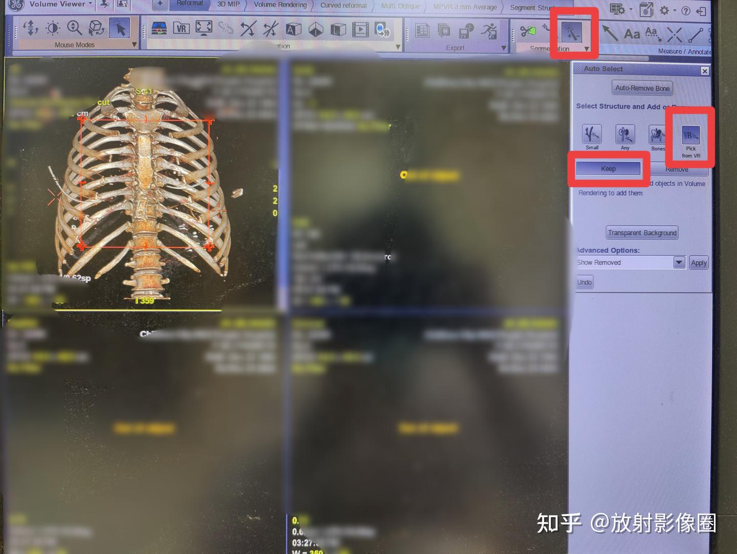 浅谈CT三维重建的操作方法 - 知乎