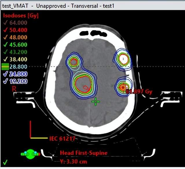 100万脑转移瘤救星【HyperArc超弧刀】——无创治疗颅内肿瘤 - 知乎